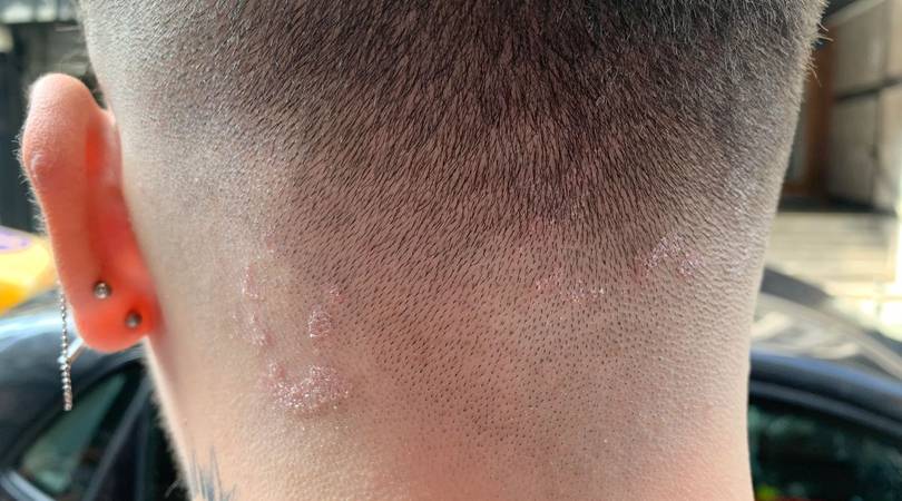 Tiña capilar: qué es, cuál es su causa y cómo prevenirlo | Chacabuco en Red